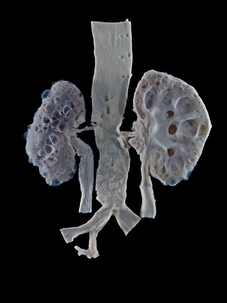 Cystic Kidneys with Bilateral Pyonephrosis | Wellcome Collection