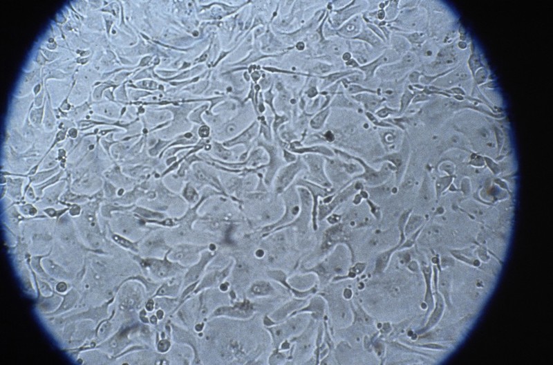 Abnormal foetal cells in amniotic fluid | Wellcome Collection