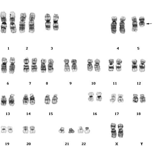 Human karyotype showing translocation between chromosomes 14 and 21, t ...