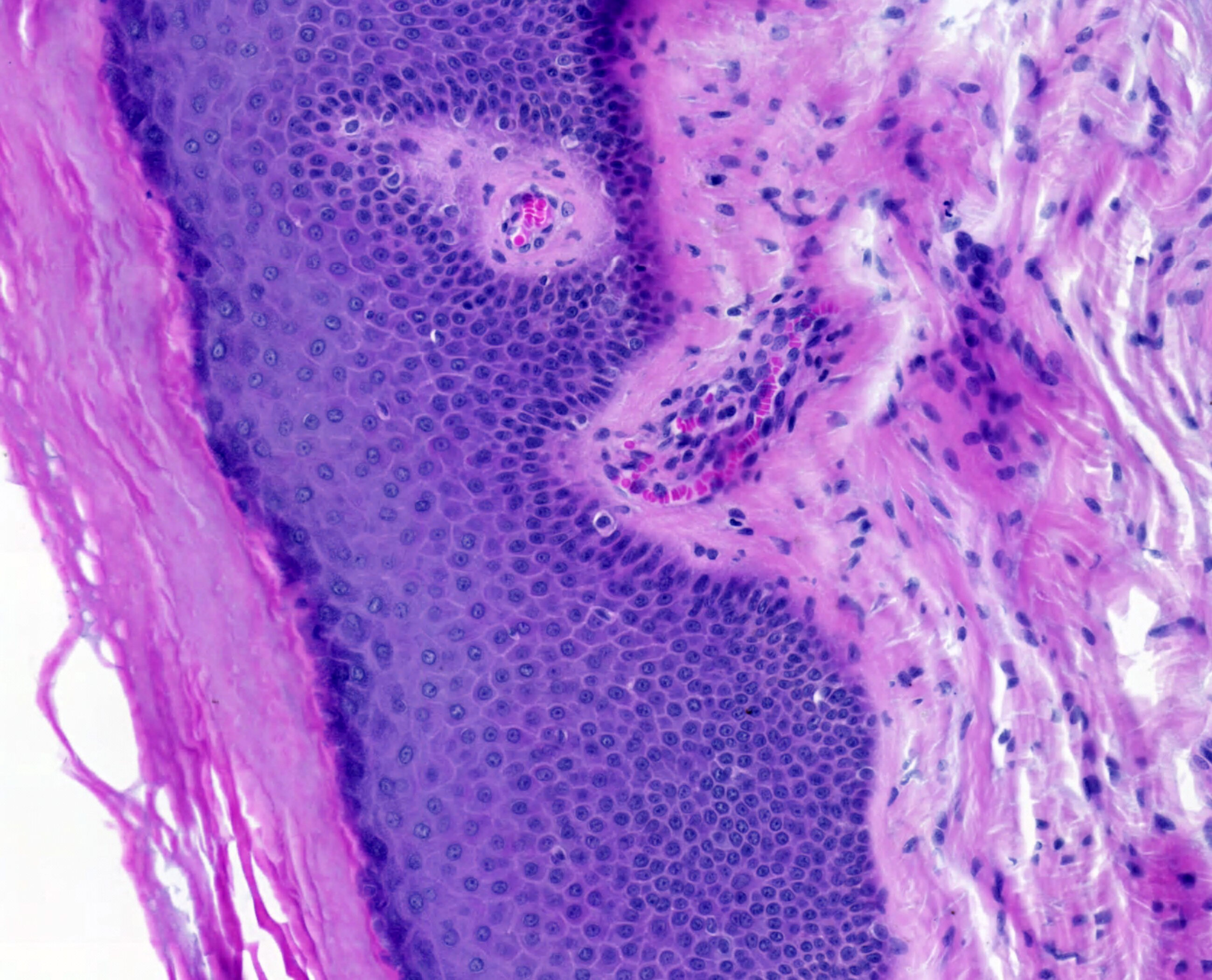 Dermatofibroma, LM | Wellcome Collection