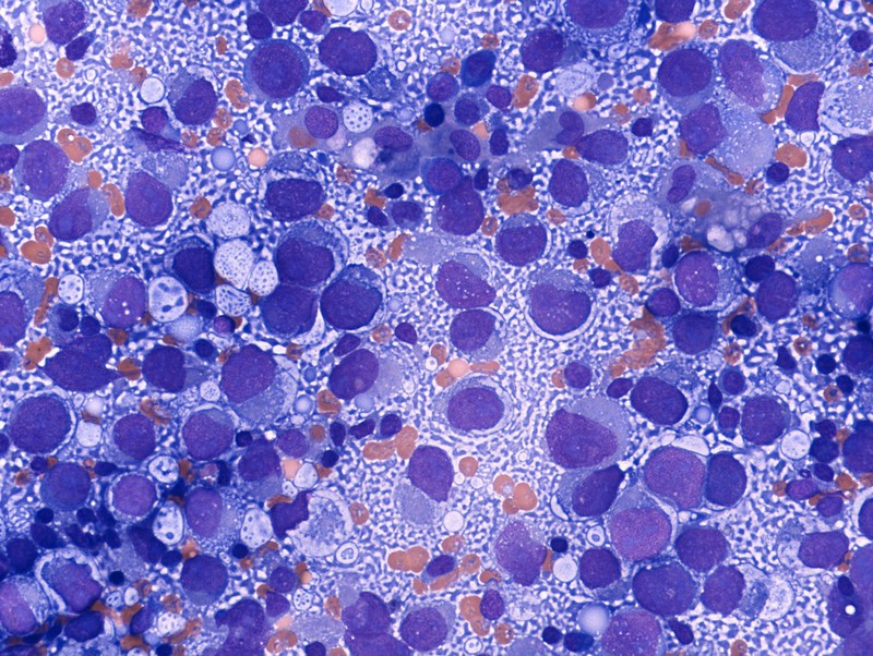 Metastatic seminoma of supraclavicular lymph node | Wellcome Collection