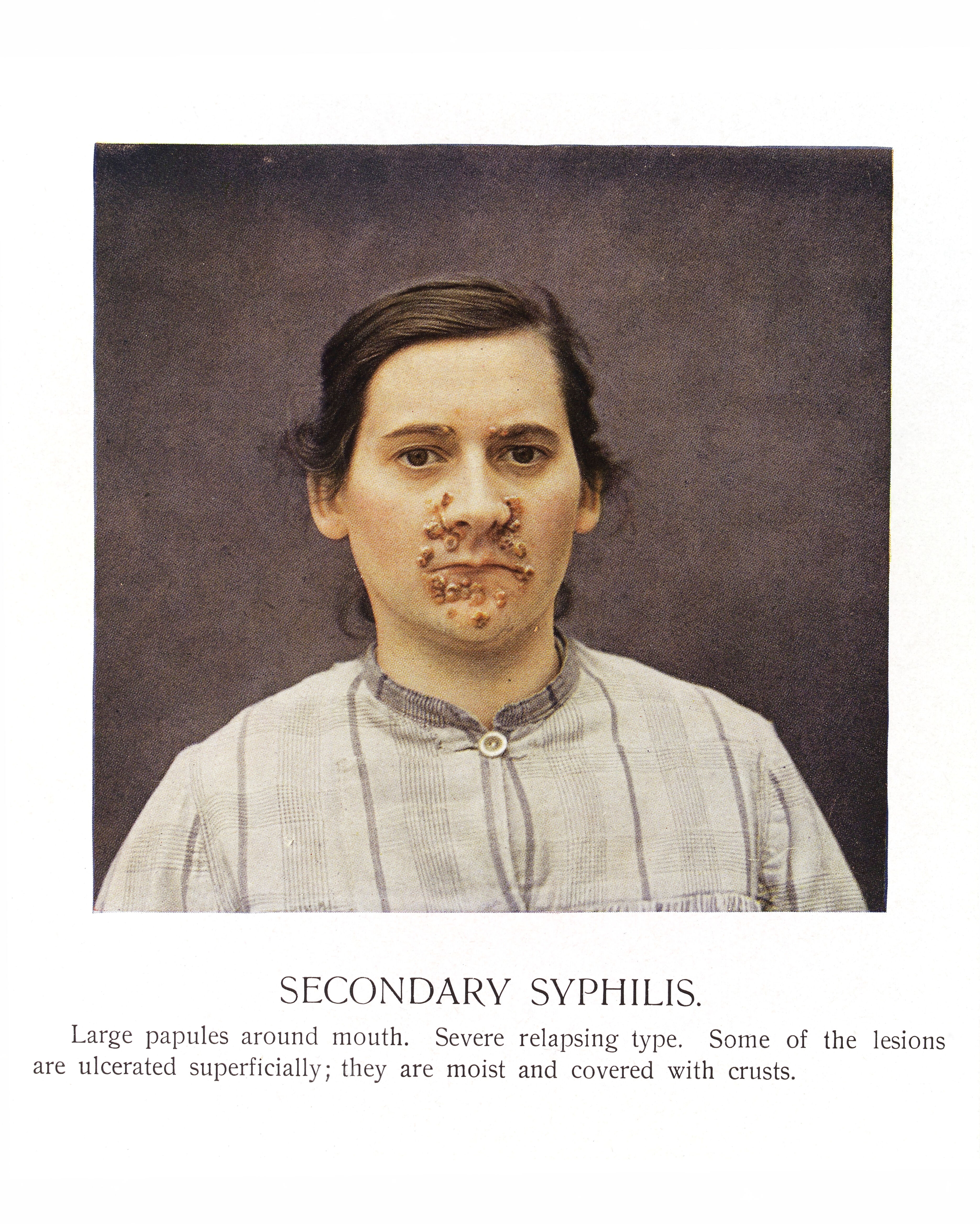 Tertiary Syphilis Face