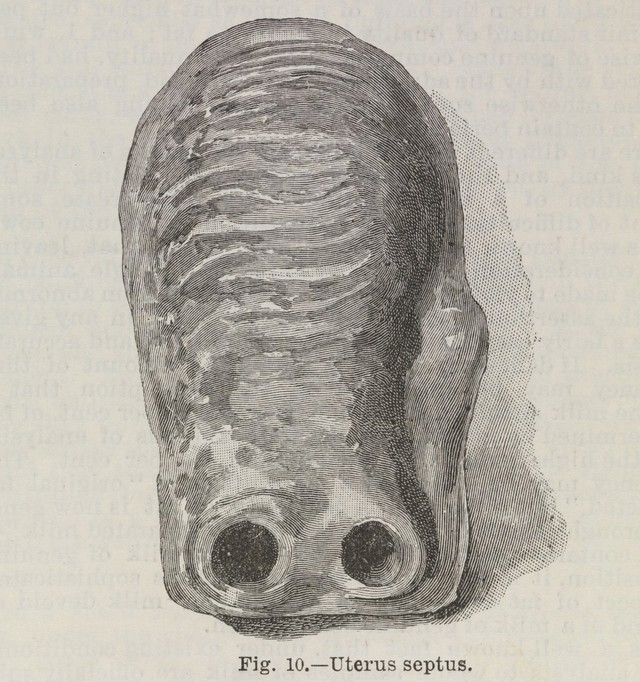 Fig. 10. - Uterus septus. | Wellcome Collection