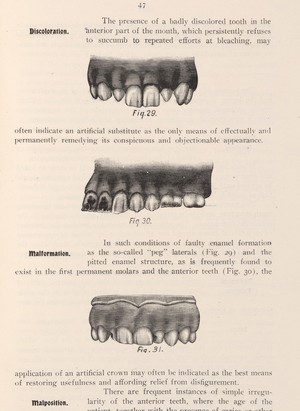 Malformed teeth examples. | Wellcome Collection