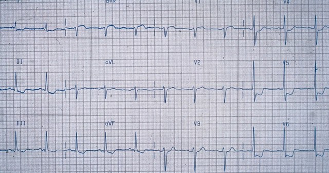 ECG trace showing unstable angina pectoris. This is the symptom of ...