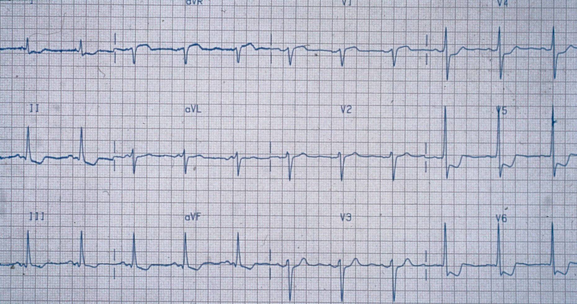 ECG trace showing unstable angina pectoris. This is the symptom of ...