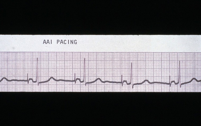 Pacing, atrial AAI | Wellcome Collection