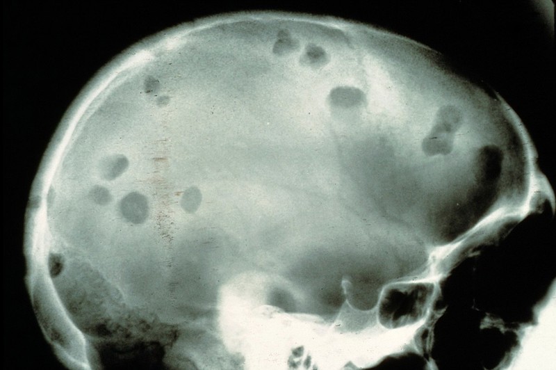 Tuberculosis skull, "button" lesions | Wellcome Collection