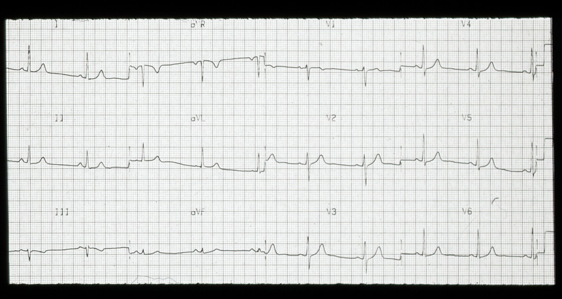 Normal Ecg