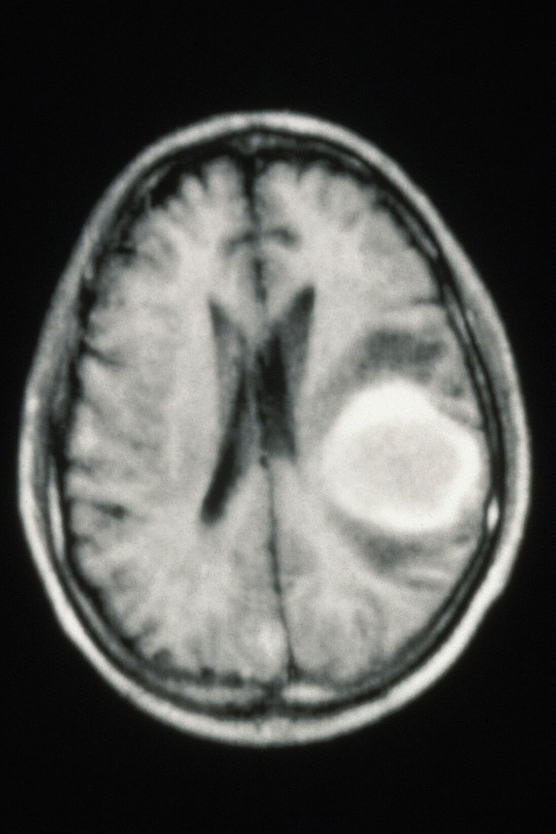 MRI scan; brain cancer, metastasis | Wellcome Collection