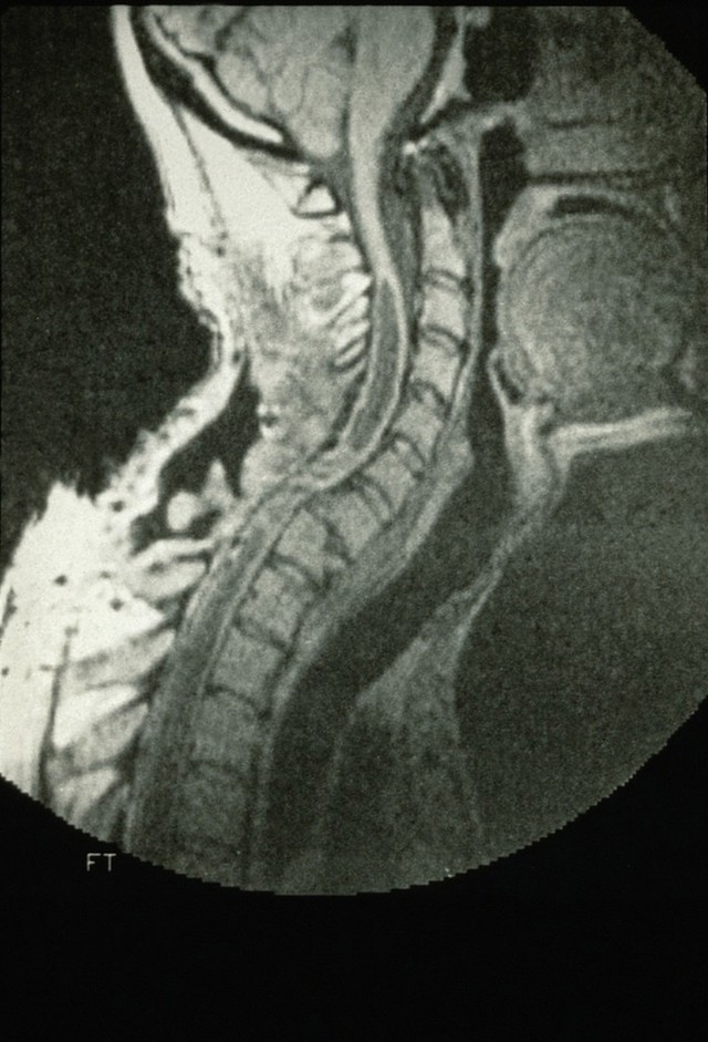 Cervical fracture dislocation C7/T1 | Wellcome Collection
