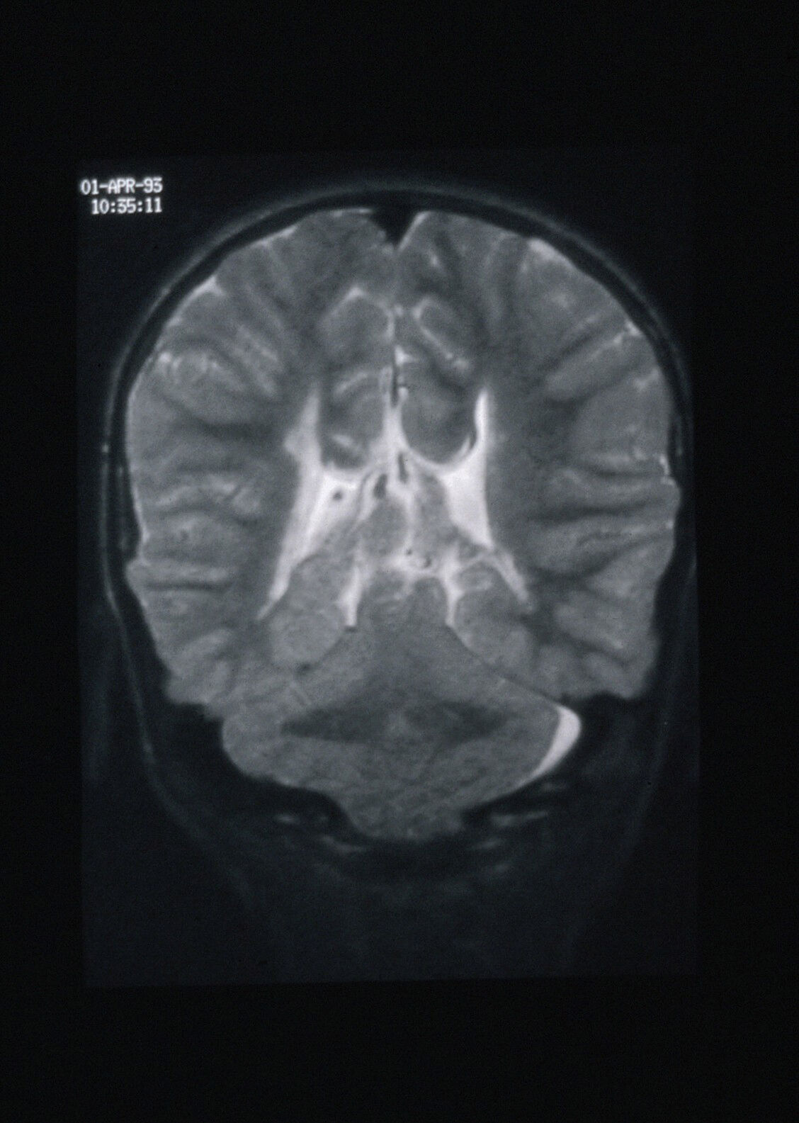 Callosal Dysgenesis | Wellcome Collection