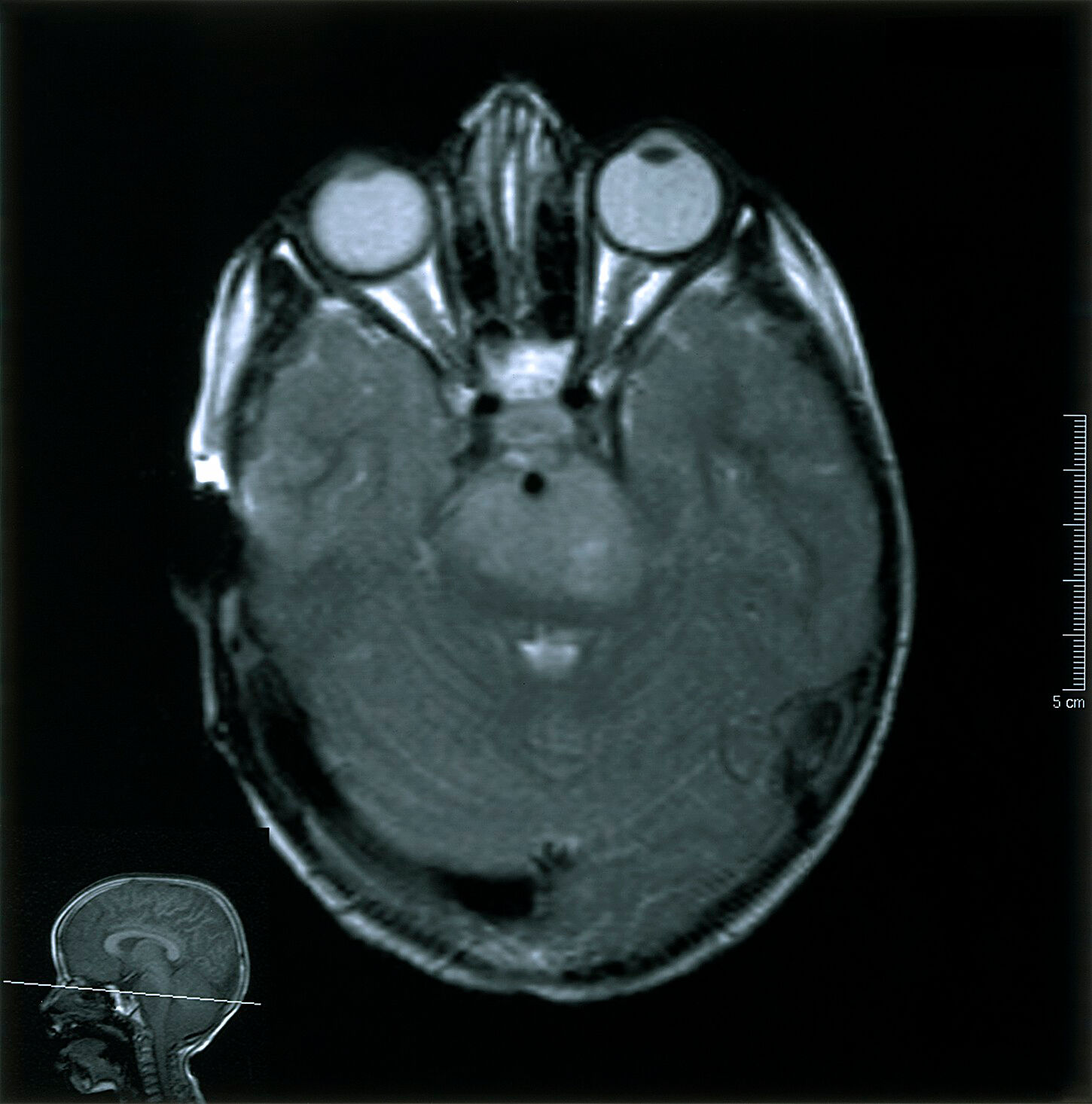 MRI scan; brain cancer (glioma), brain stem | Wellcome Collection MRI scan; brain cancer (glioma), brain stem | Wellcome Collection