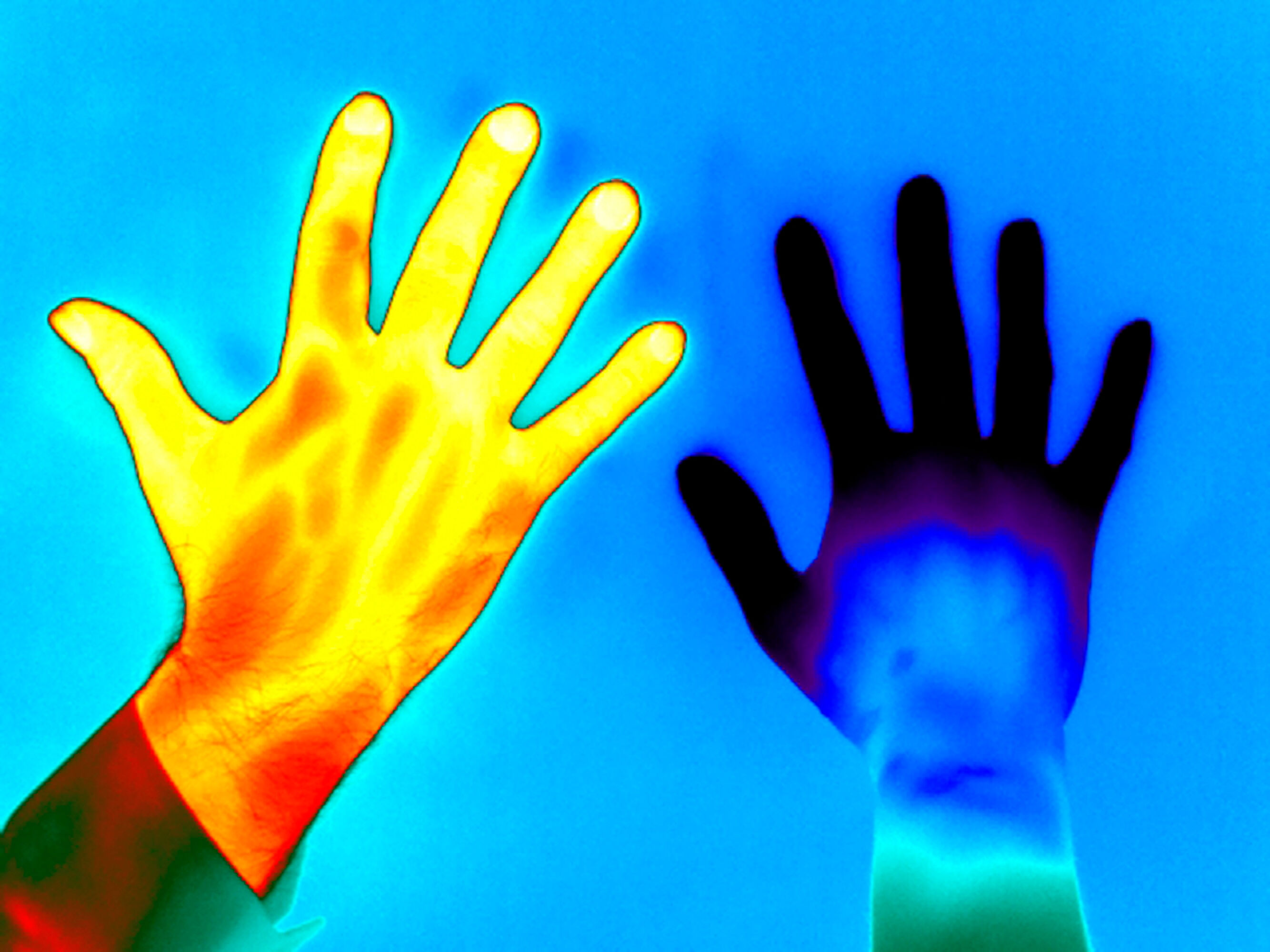Raynaud's Phenomenon | Wellcome Collection