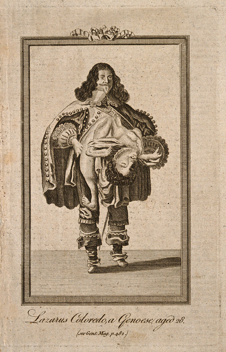 Lazzaro and Giovanni Battista Colloredo, a man with an incomplete human ...