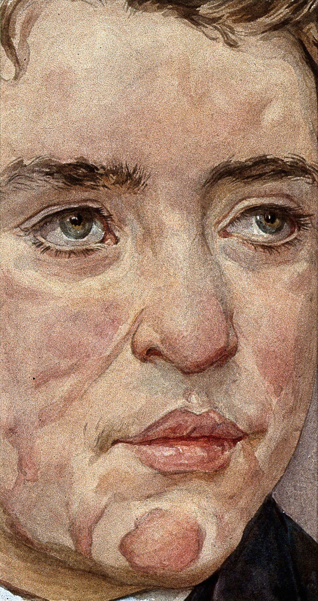 Elephantiasis (lymphatic filariasis): red swellings on a man's face ...