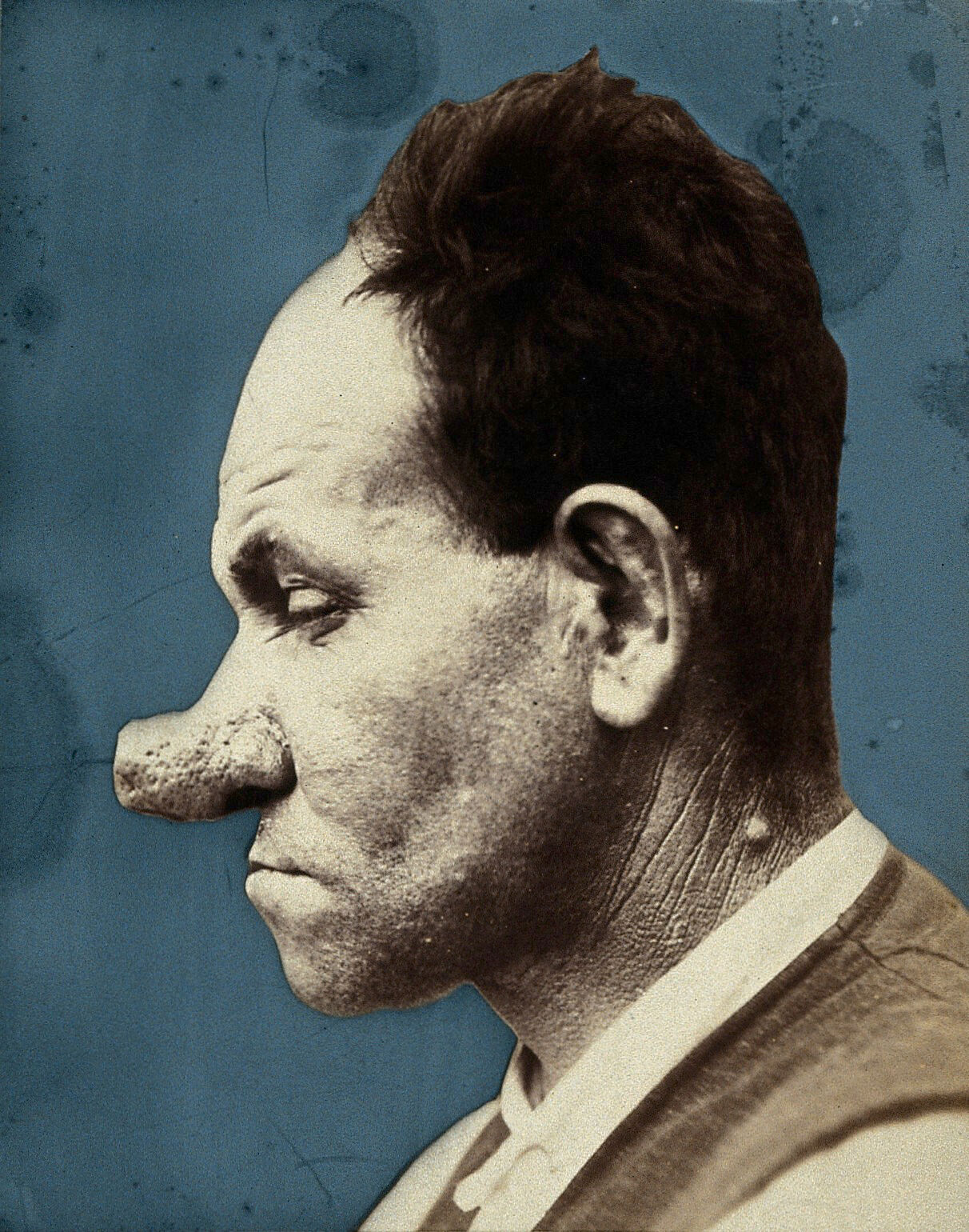 A man with a large, deformed nose diagnosed as caused by hypertrophic ...