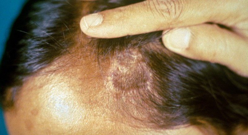 Early syphilis (secondary stage) | Wellcome Collection