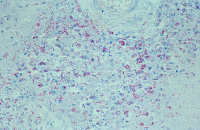 Tuberculous meningitis | Wellcome Collection