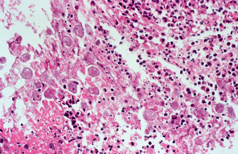 Skin: cutaneous amoebiasis | Wellcome Collection