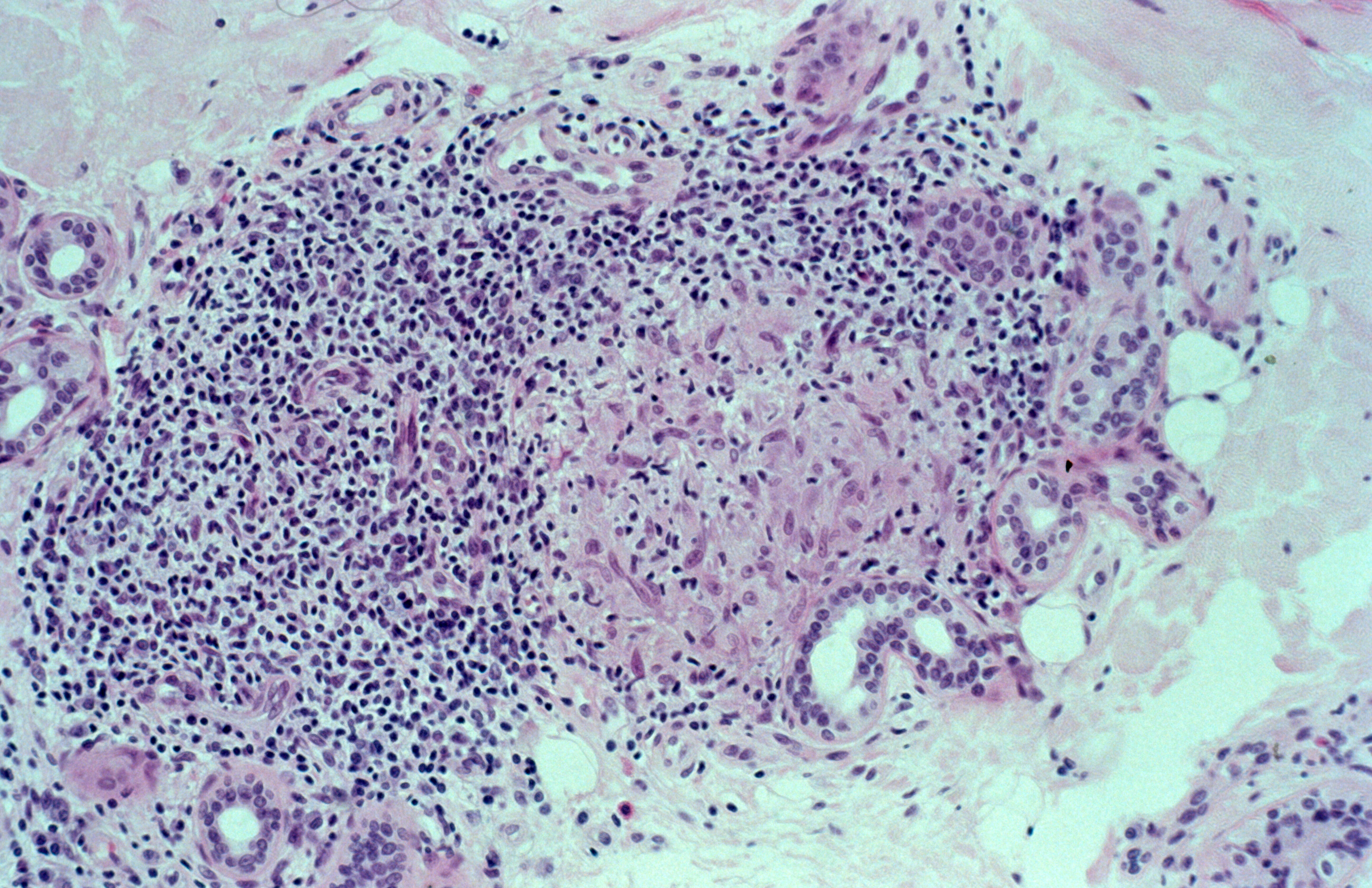 Leprosy: borderline tuberculoid leprosy, skin | Wellcome Collection