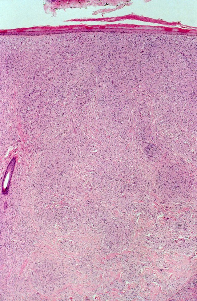 Lepromatous leprosy: histoid leprosy | Wellcome Collection