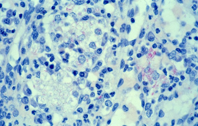 Lepromatous leprosy: spleen | Wellcome Collection