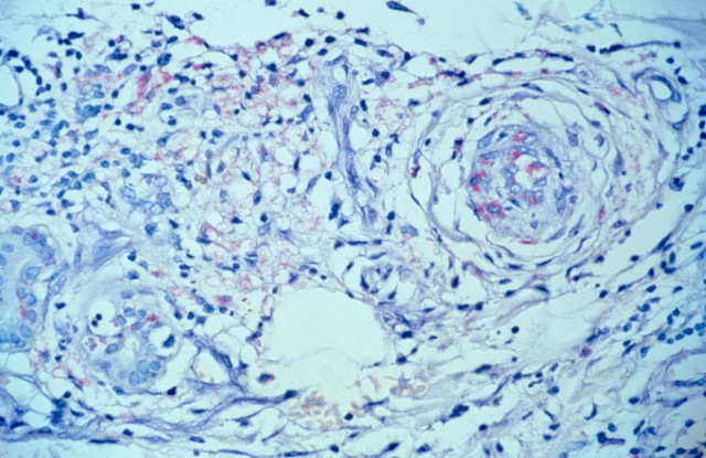 Diffuse lepromatous leprosy: Lucio phenomenon | Wellcome Collection
