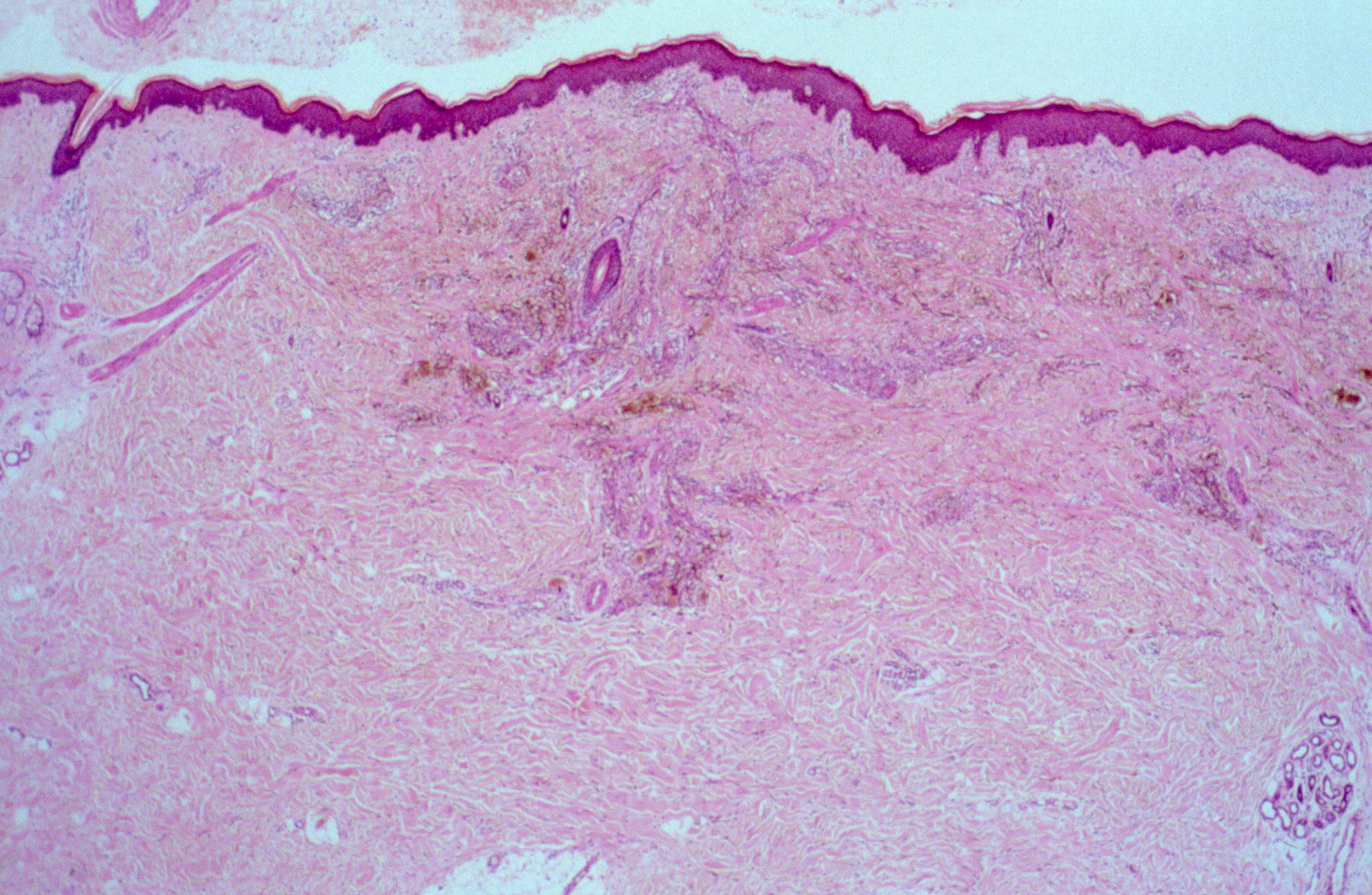 What Does Kaposi Sarcoma Lesions Look Like at David Jasmin blog