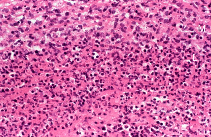 Cutaneous leishmaniasis: skin lesion | Wellcome Collection