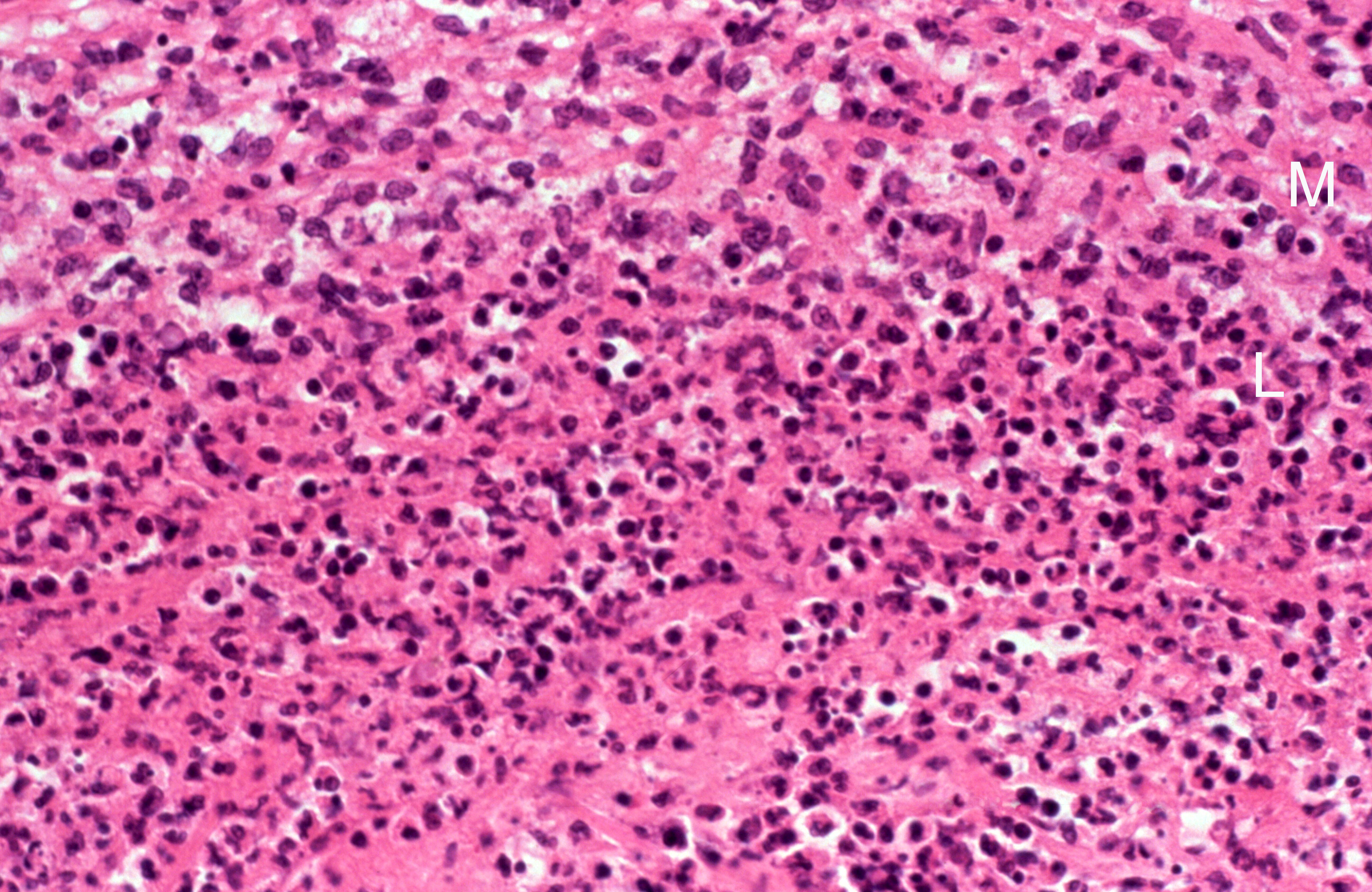 Cutaneous leishmaniasis: skin lesion | Wellcome Collection