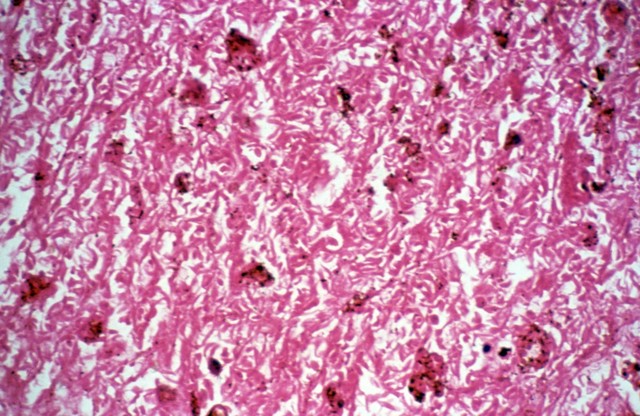 Sickle cell disease: liver | Wellcome Collection