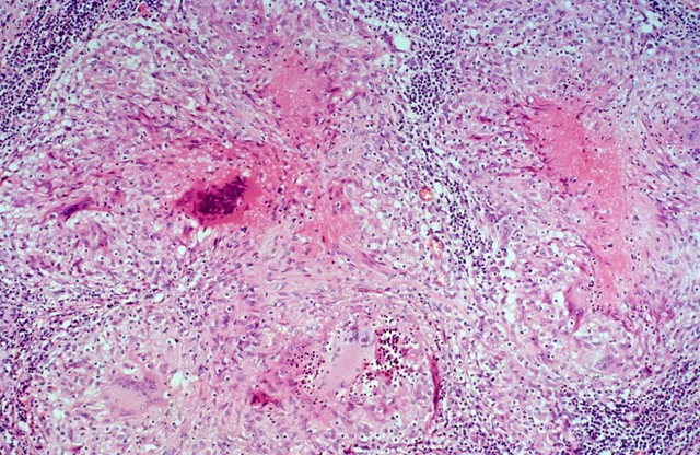 Tuberculous lymphadenitis | Wellcome Collection