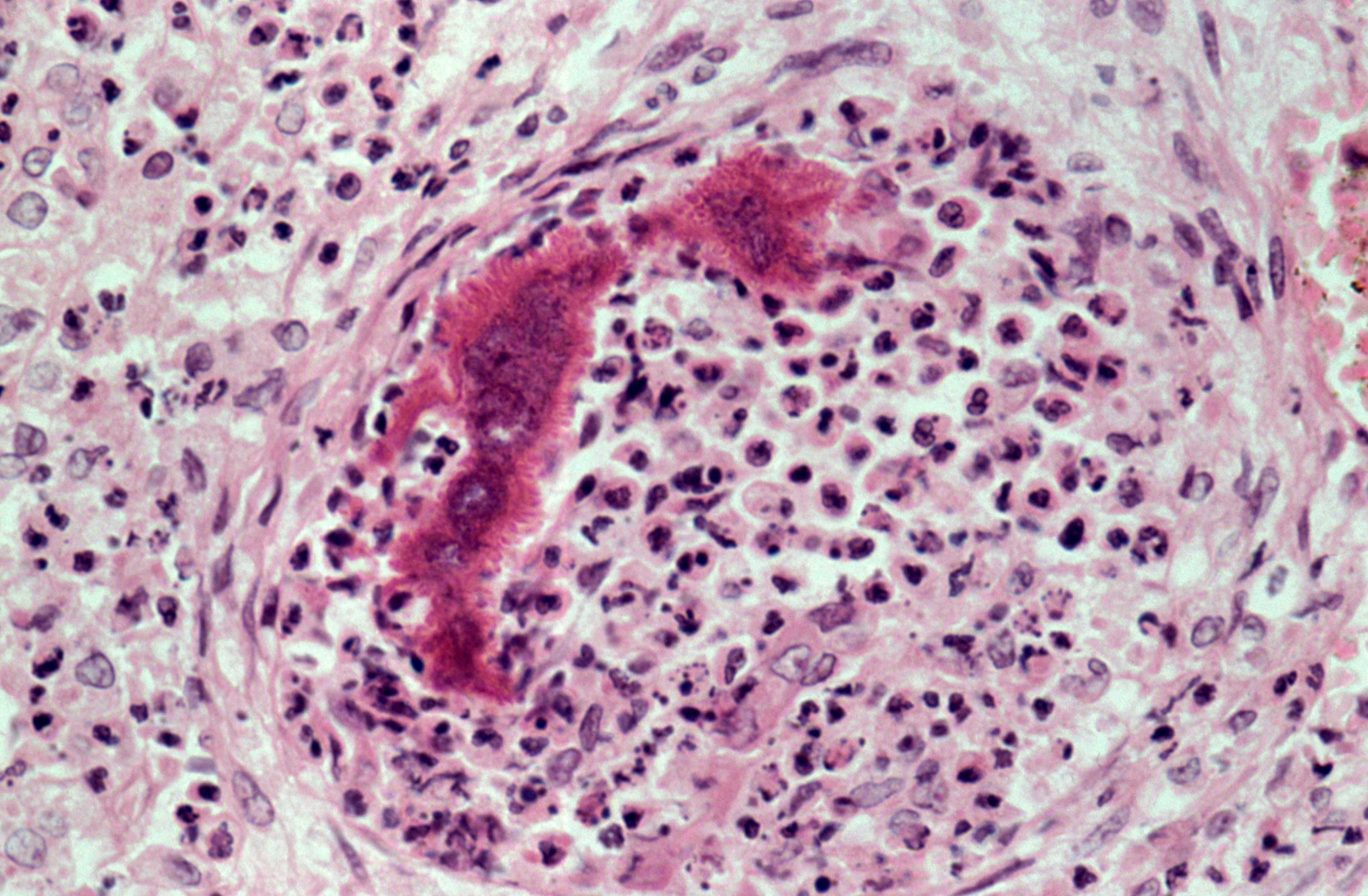 Kidney: pyaemic abscess | Wellcome Collection