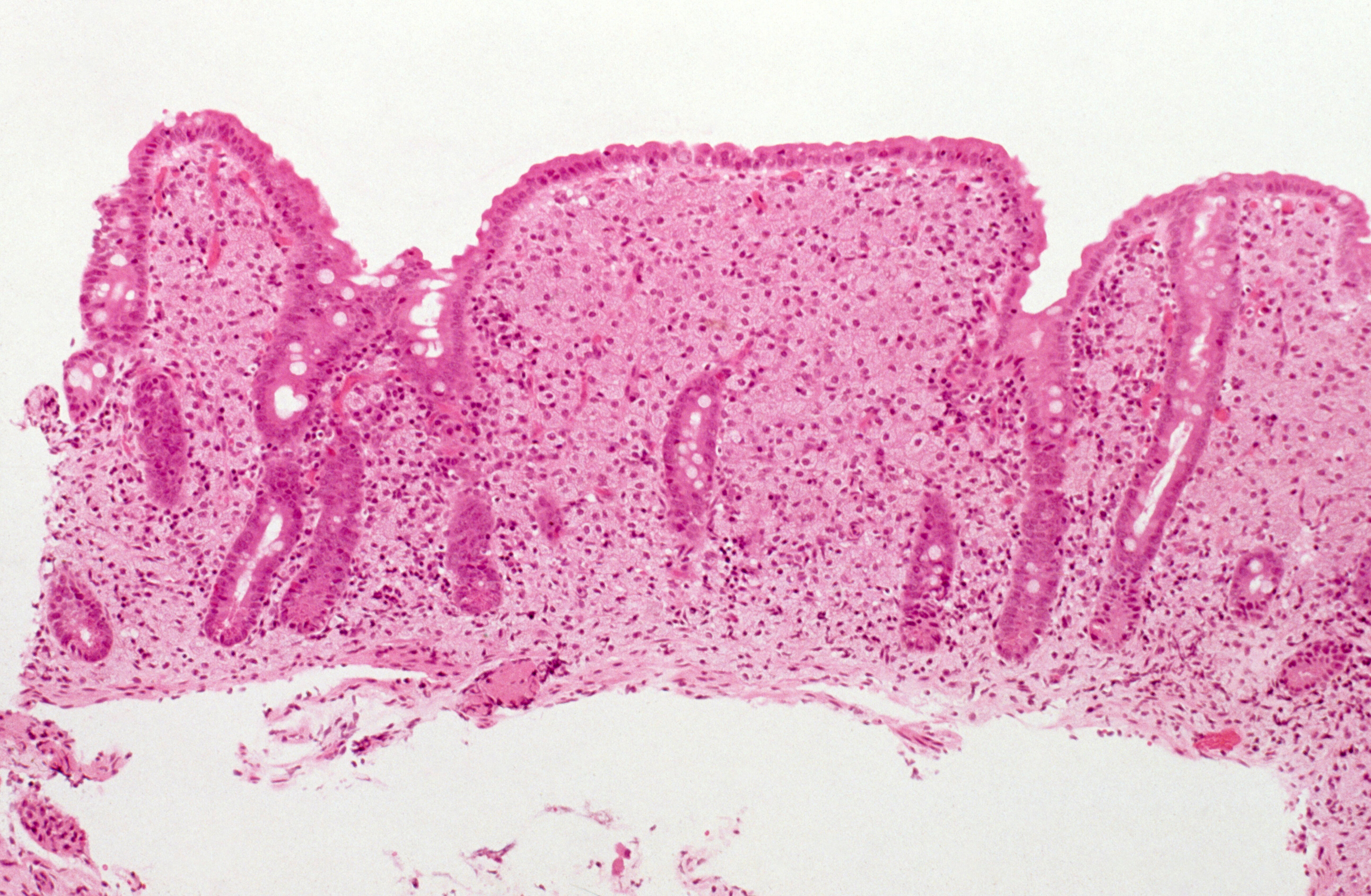 Duodenum: Mycobacterium avium infection with HIV | Wellcome Collection