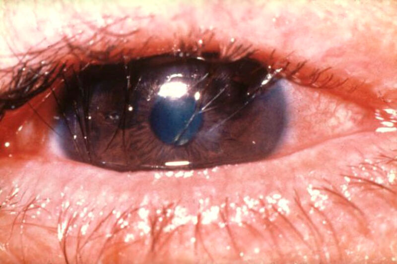 Trachoma WHO grade: trachomatous trichiasis (TT) | Wellcome Collection